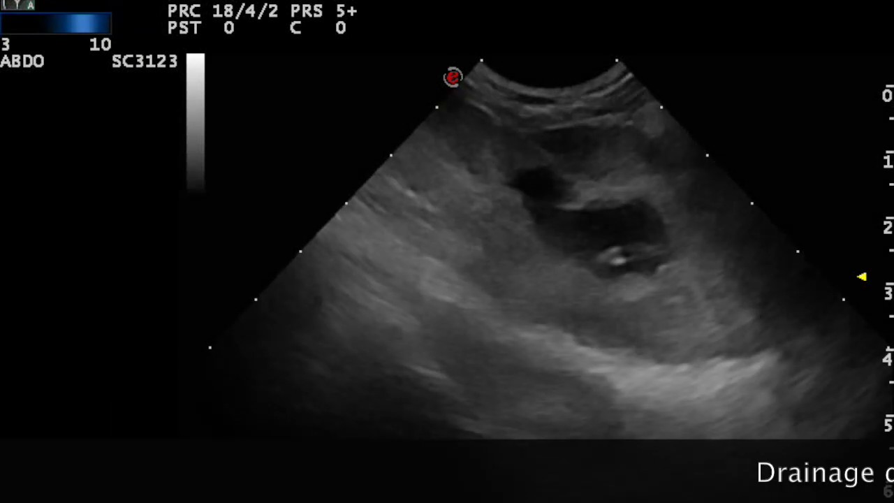 Drainage échoguidé d'un abcès prostatique au CRECS en vidéo ...